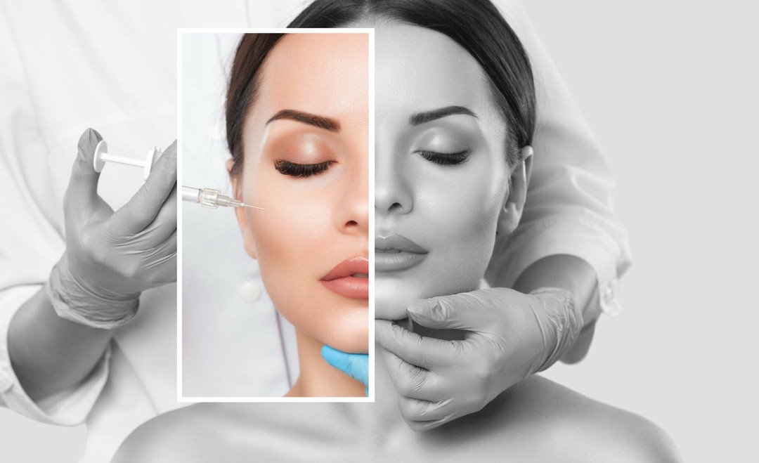 Let’s Talk Dermal Fillers! - Skin Damsel Aesthetics