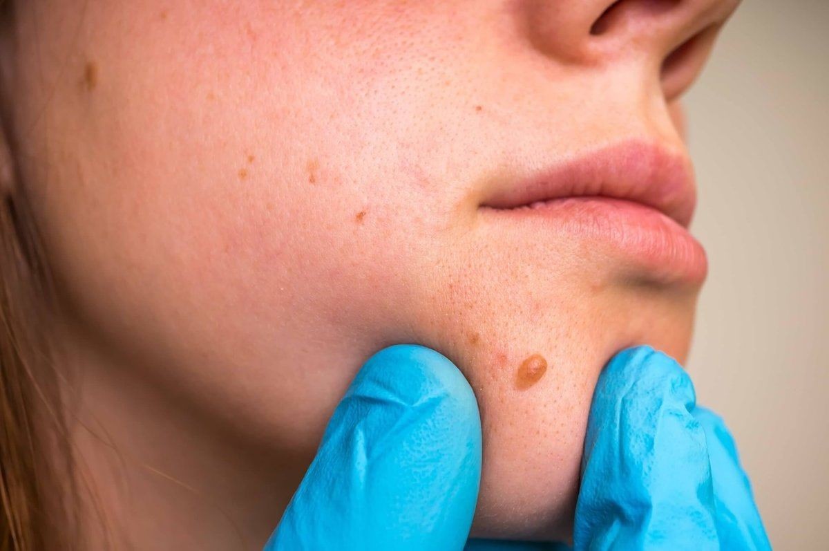 Which Skin Tag Removal Methods Work? | Skin Damsel Aesthetics